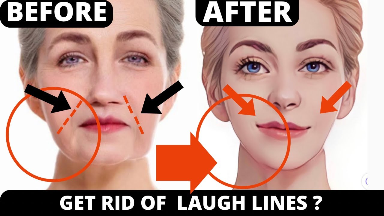 GET RID OF LAUGH LINES WITH FACE YOGA | LIFT SMILE LINES (NASOLABIAL ...