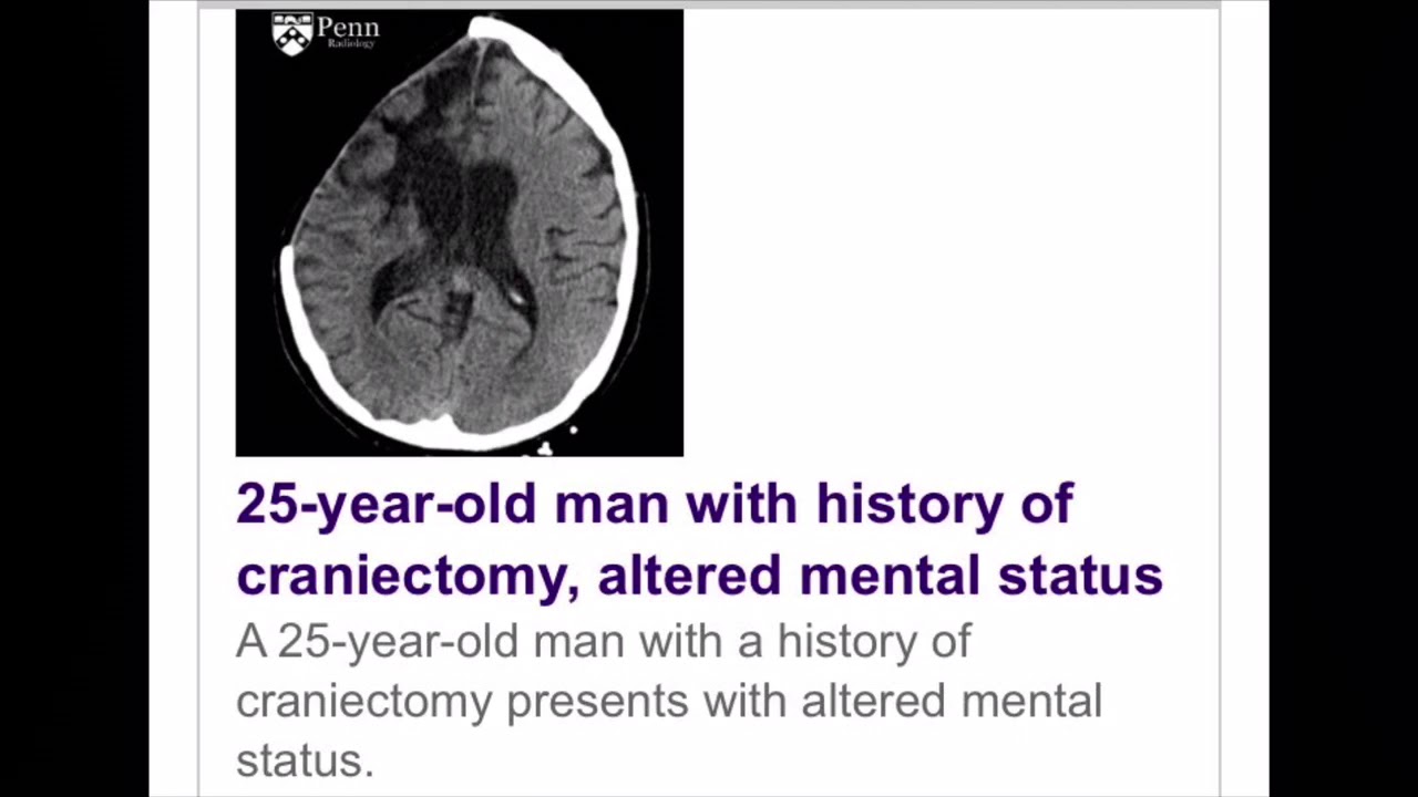 Sinking skin flap syndrome (SSFS) - YouTube