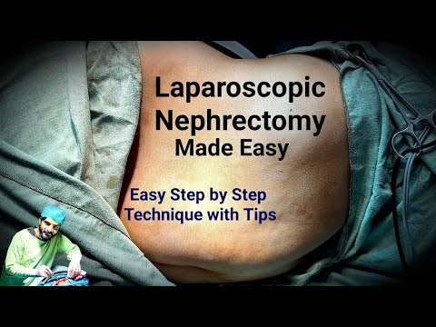 Laparoscopic Nephrectomy | Step by Step with Tips - Dr Tayyab Riaz Ch ...