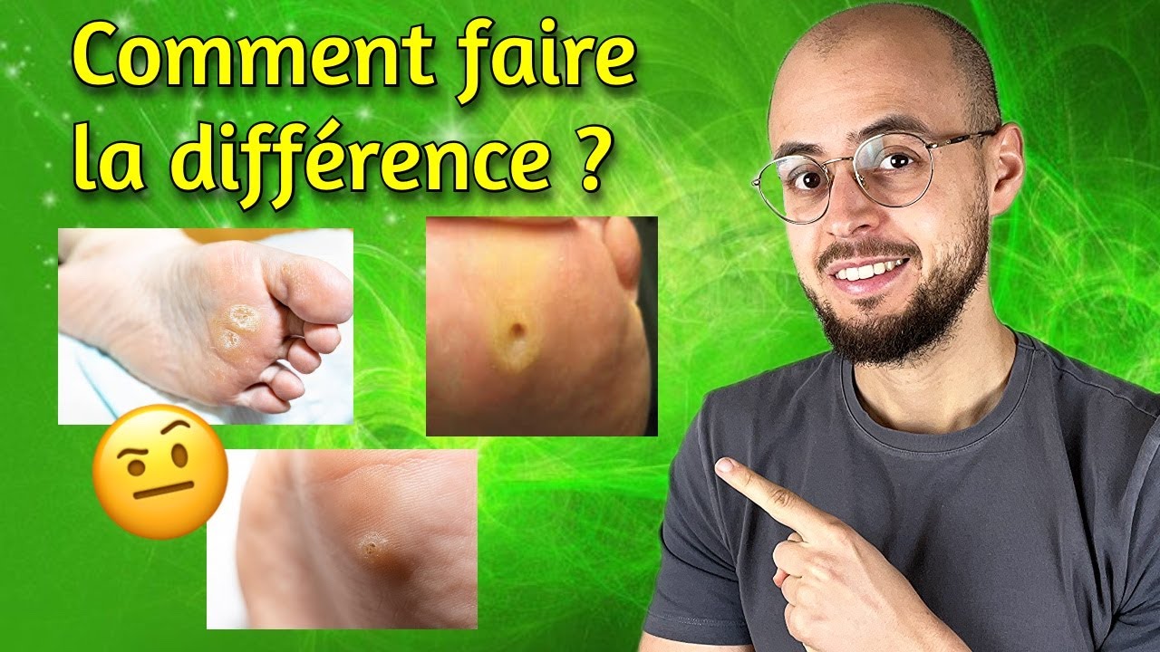 Cor VS Durillon VS Verrue au pied : Comment les reconnaitre ? - YouTube