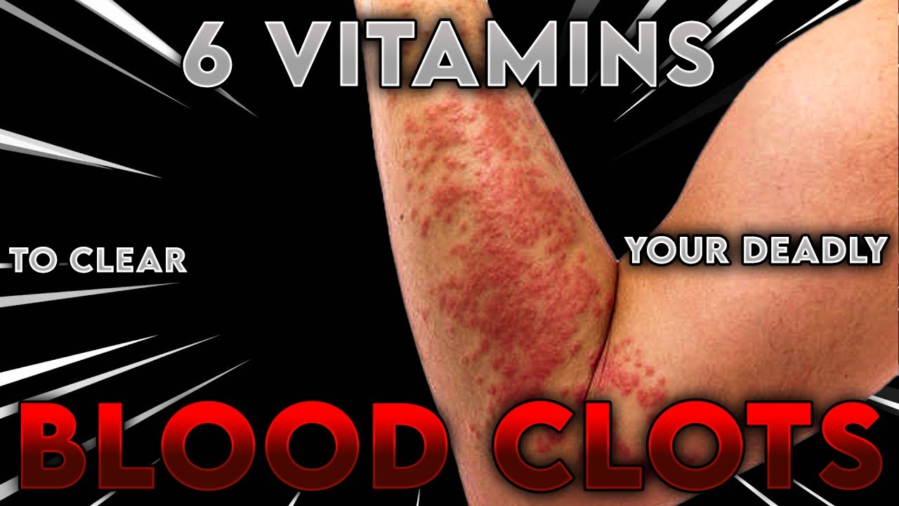 6 Vitamins to clear your deadly blood clots - YouTube