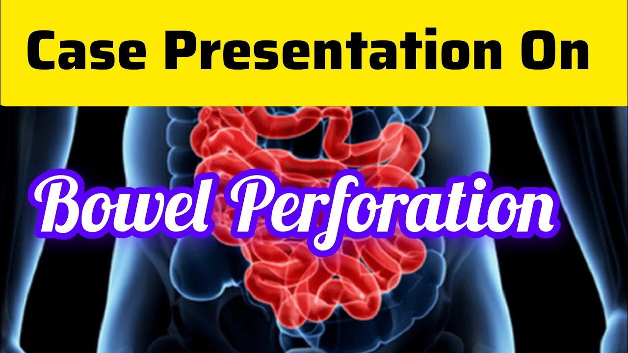 Case Presentation On Bowel Perforation#ncp#casestudy#bowelperforation ...