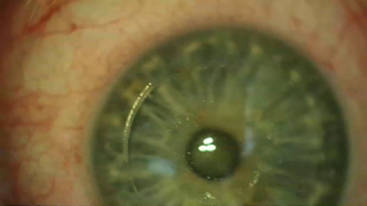 Raindrop Inlay Dr. Bret Fisher - YouTube