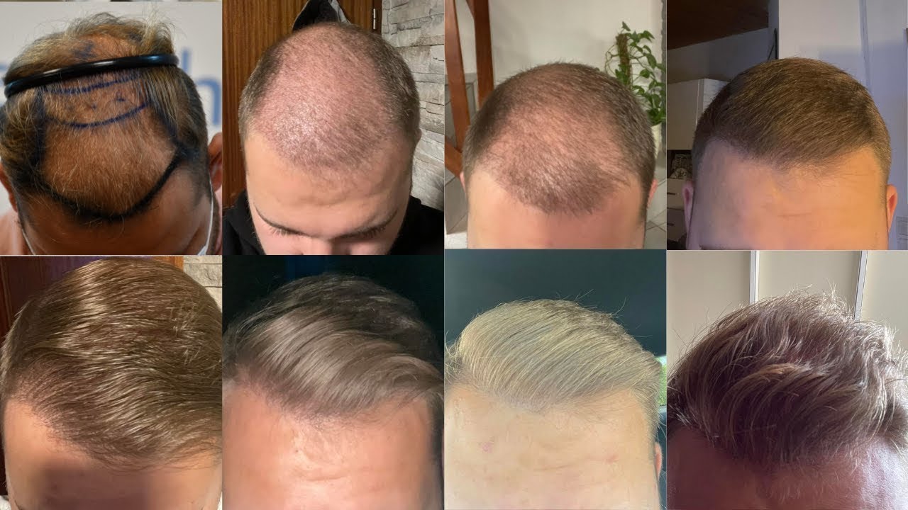 Haartransplantation Tonsur: Vorher Nachher - YouTube