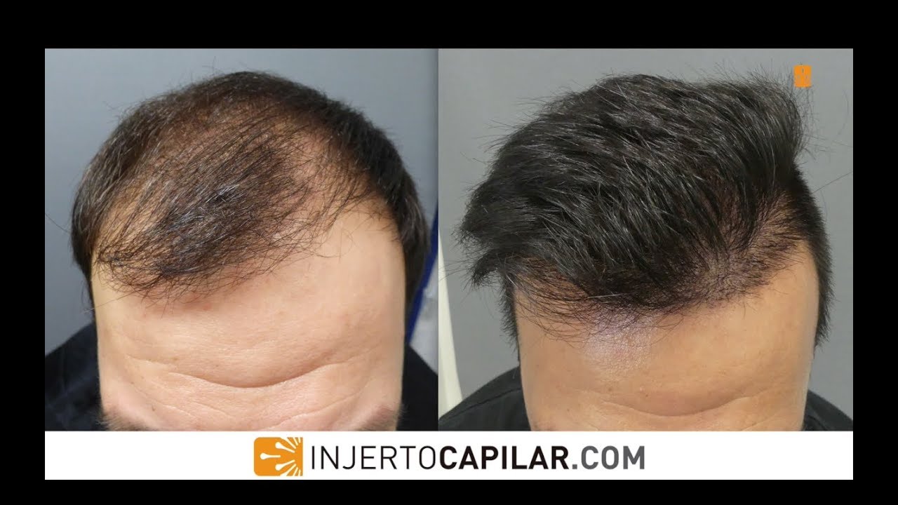5904 Grafts. NWV. Early regrowth in both procedures. Shaved, Temporal ...