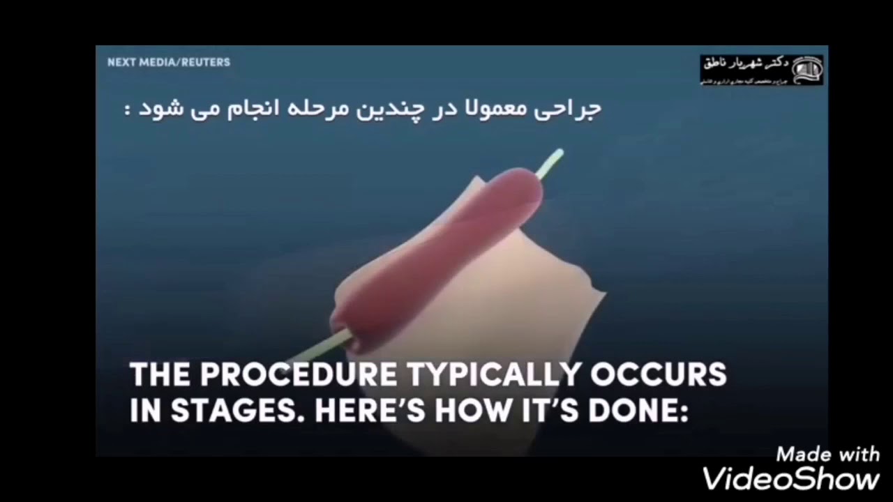تغییر جنسیت و ترنس روش تغییر جنسیت زن به مرد Youtube