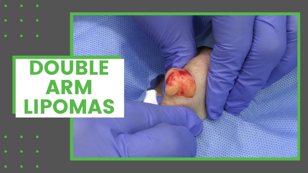 Double Arm Lipomas | Dr. Derm - YouTube