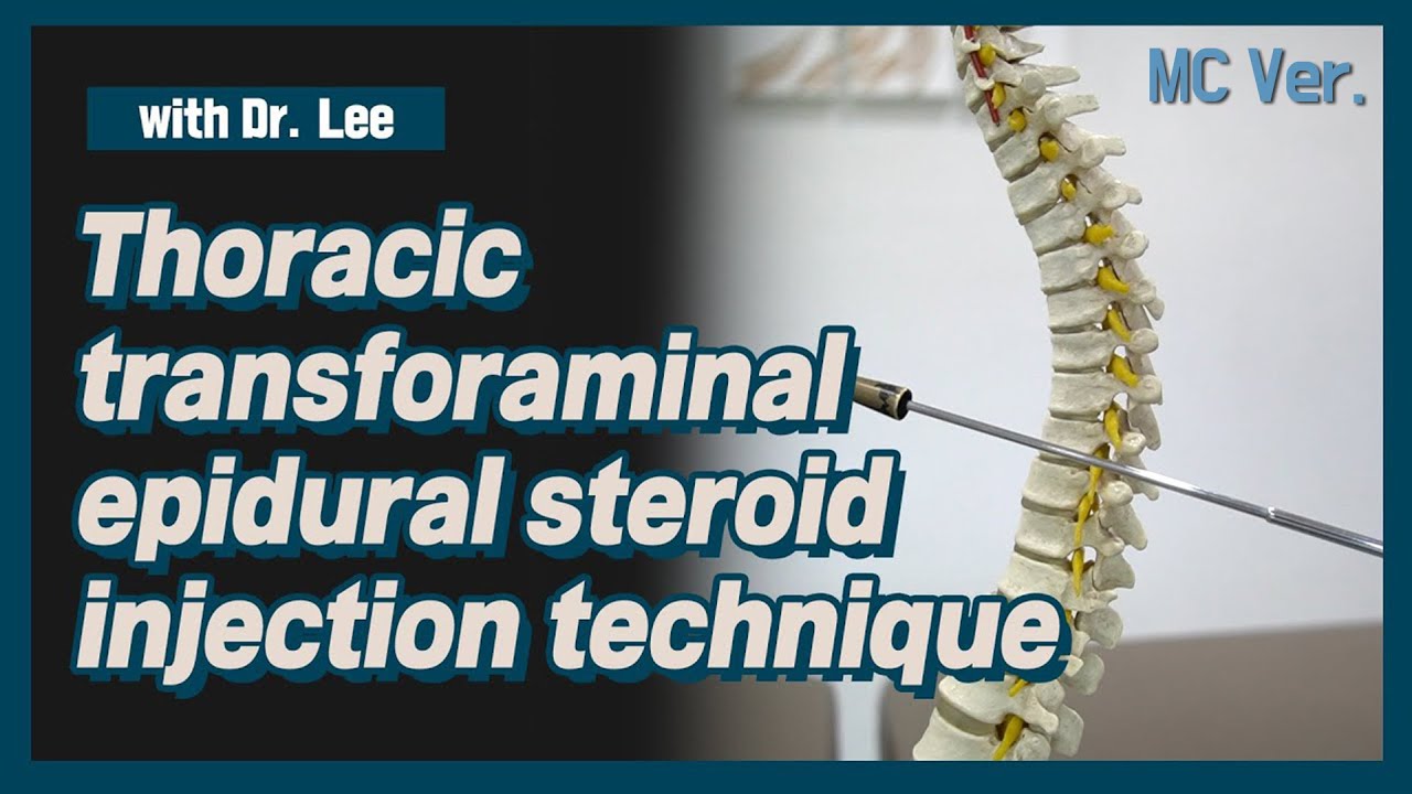 MC_Thoracic transforaminal epidural steroid injection technique under ...