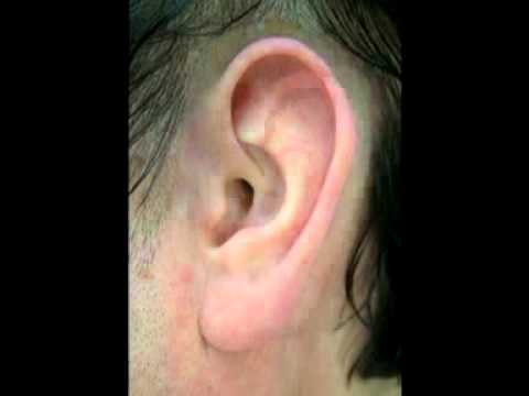 Prosthetic ear informational video - YouTube