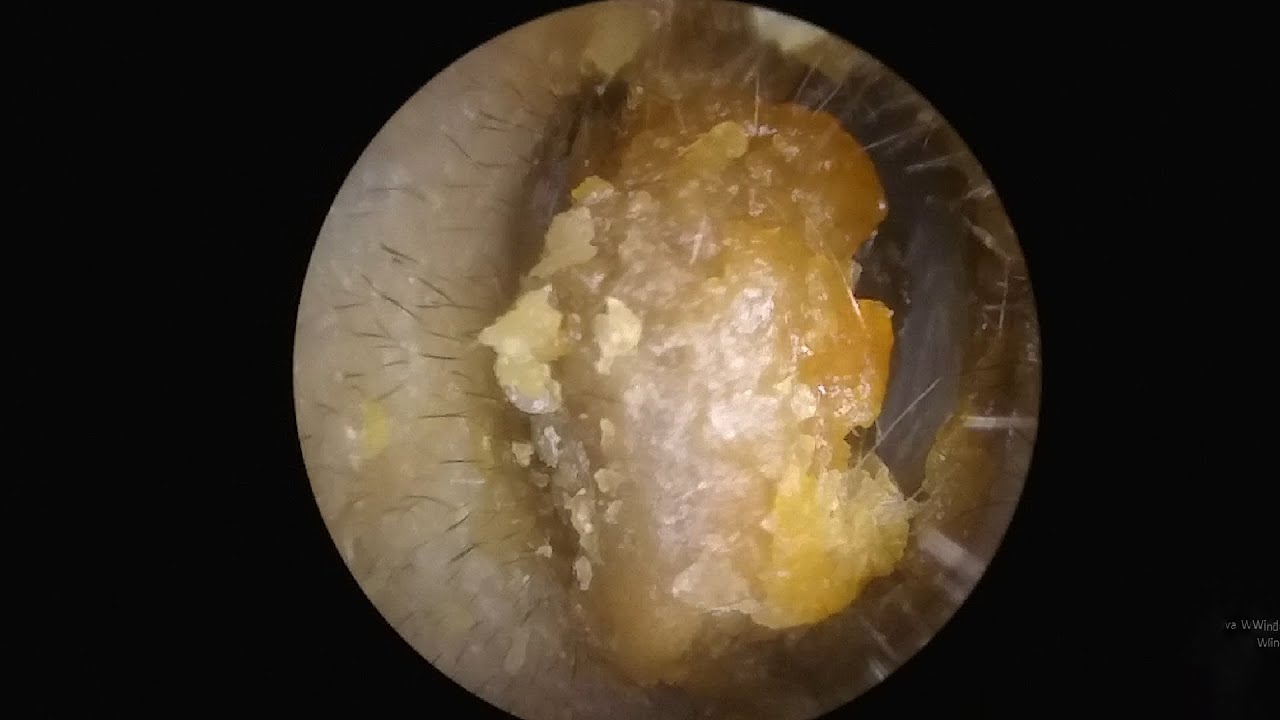 Satisfying Earwax Removal You Can’t Stop Watching - YouTube