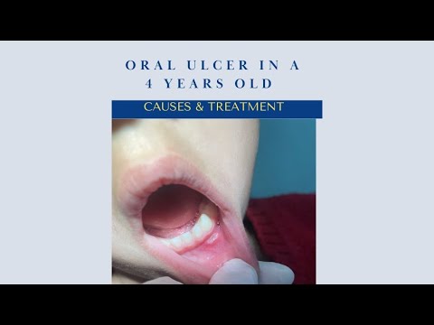 How to treat mouth ulcer in 4 years old child? - YouTube