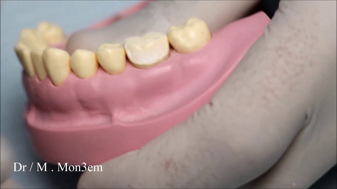 Full Veneer metal crown prep - YouTube