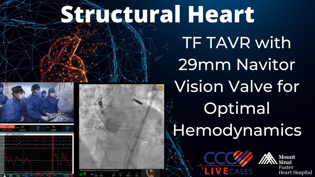 TF TAVR with 29mm Navitor Vision Valve for Optimal Hemodynamics - YouTube