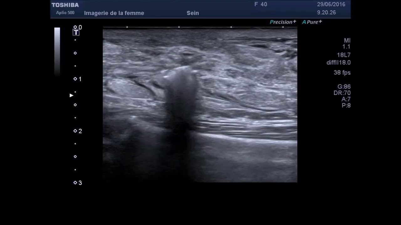 MACROBIOPSIE SOUS ECHOGRAPHIE - YouTube