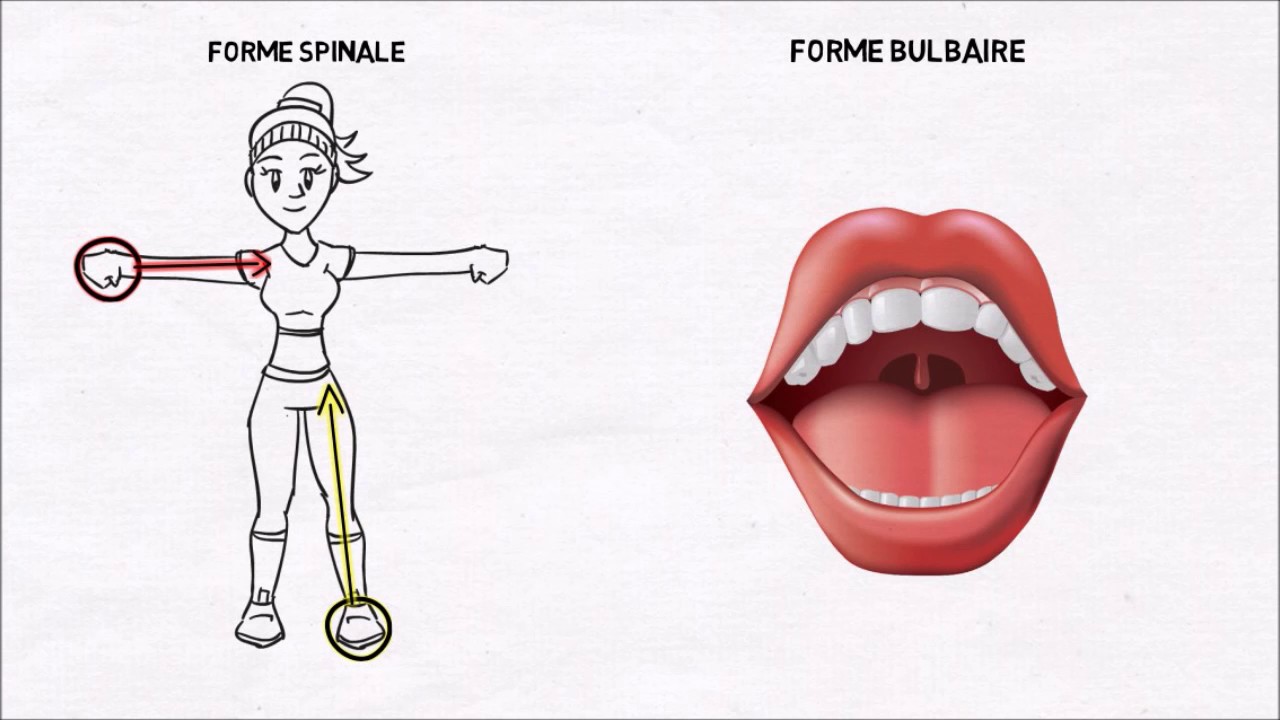 La sclérose latérale amyotrophique - YouTube