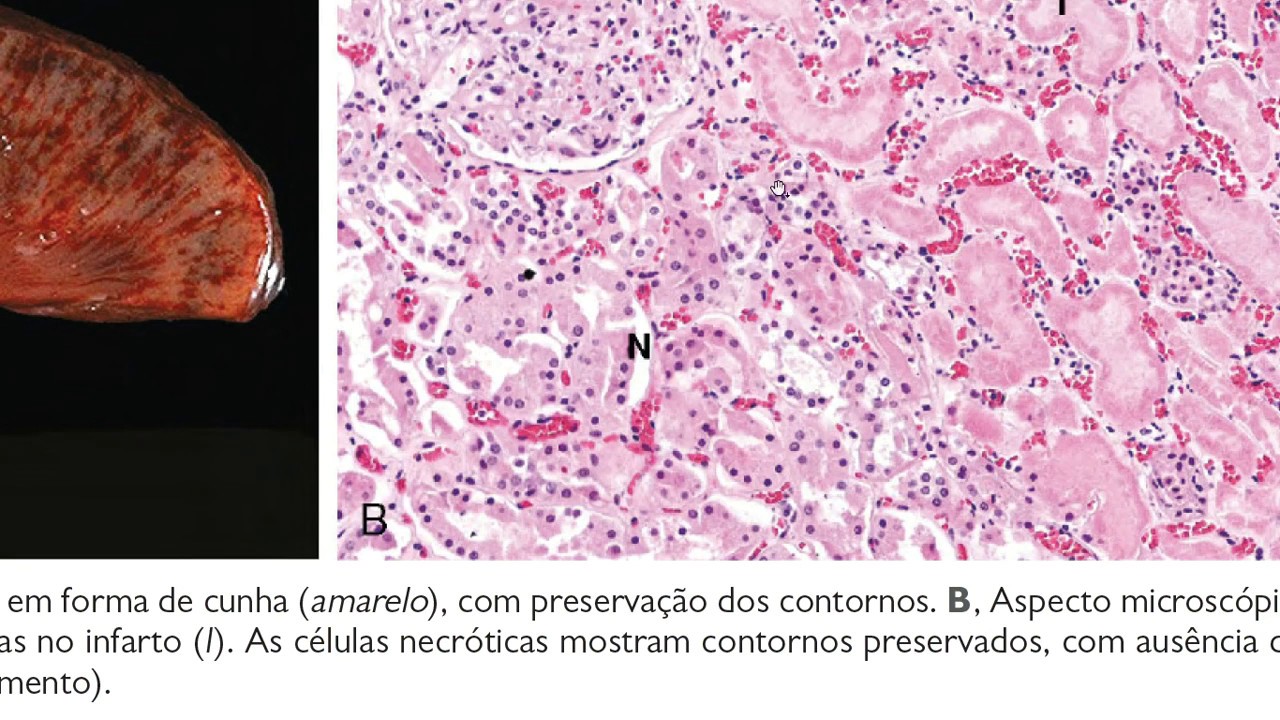 NECROSE E APOPTOSE - YouTube