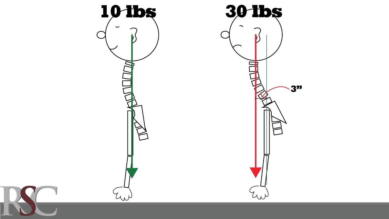 Forward Head Posture & Preventing Spinal Degeneration - YouTube