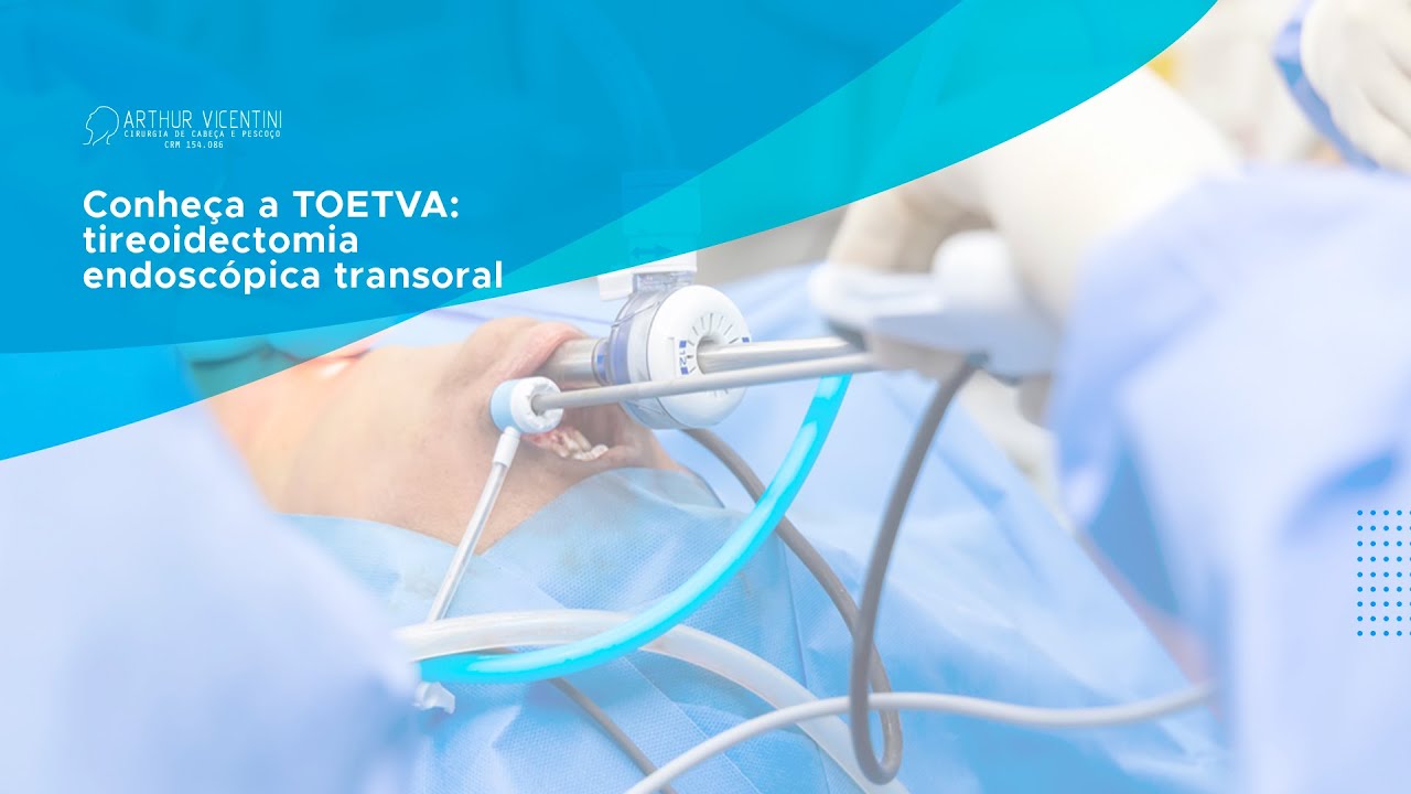 Conheça a TOETVA: tireoidectomia endoscópica transoral | Dr. Arthur ...