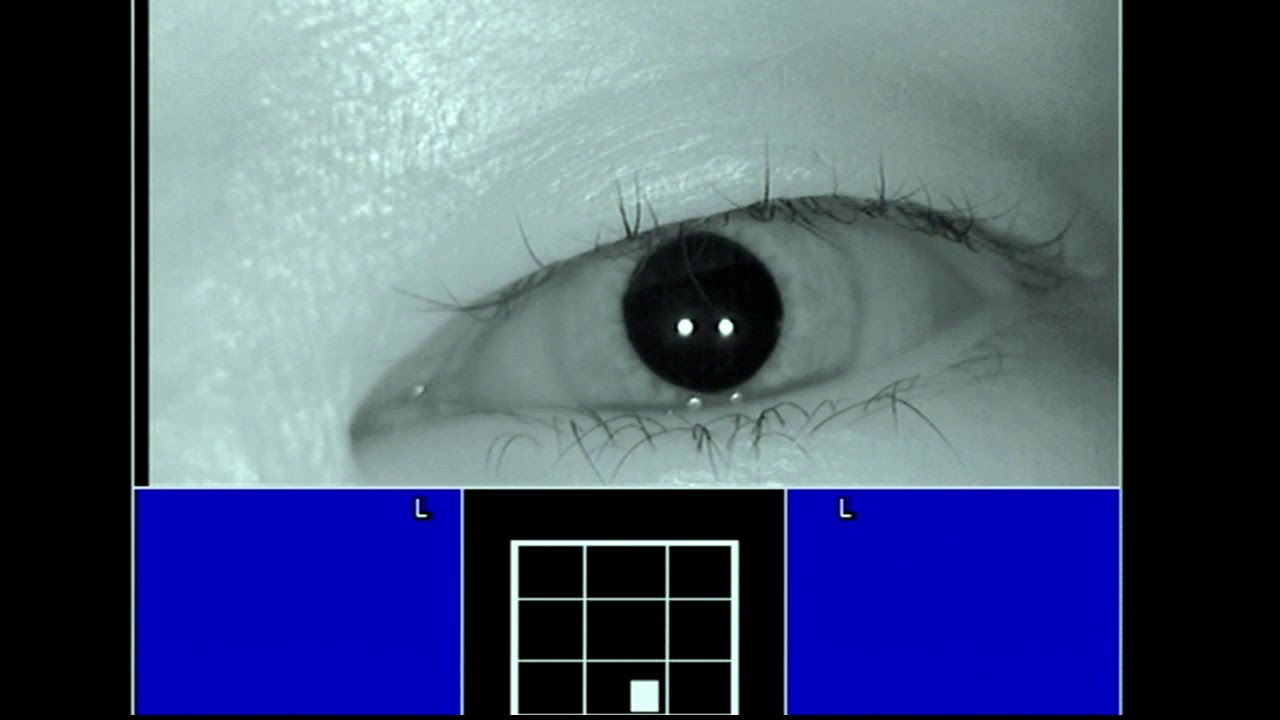 Right Posterior Canal BPPV (p-BPPV canalithiasis) - YouTube