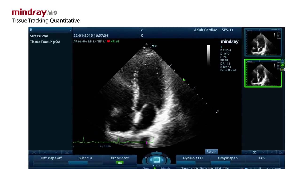 Tissue Tracking Cuantitativo en Mindray M9 - YouTube