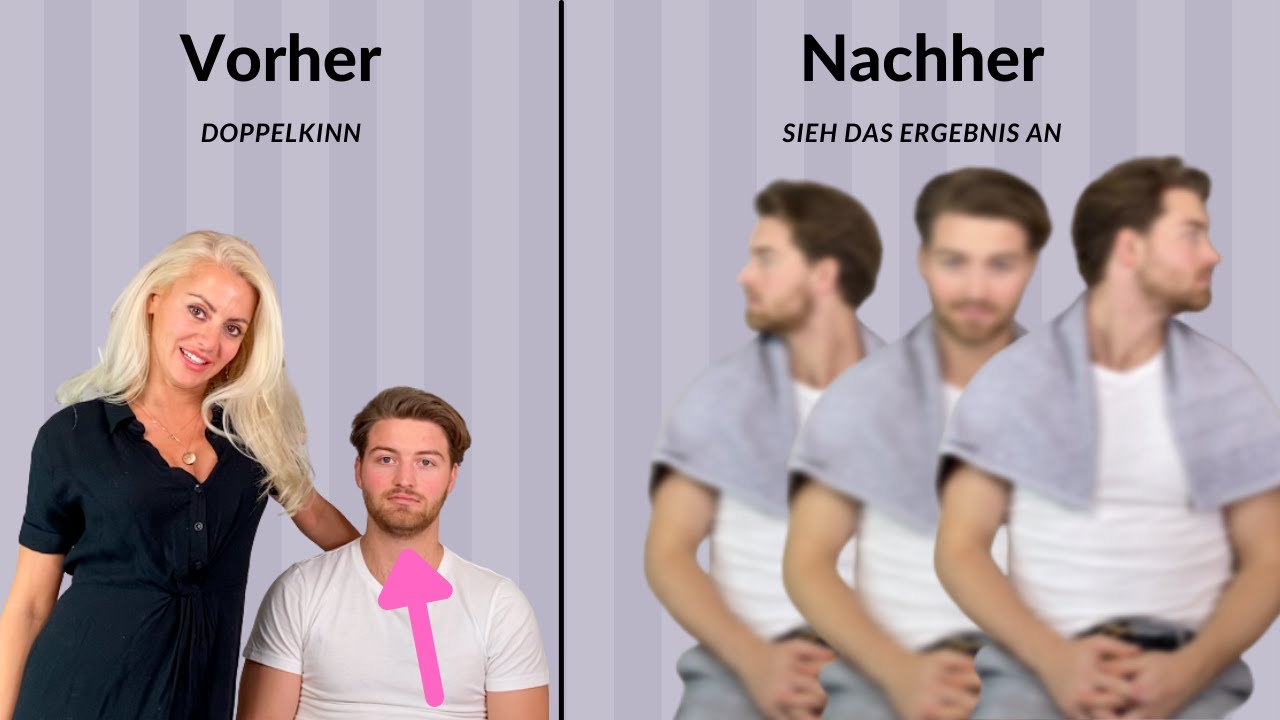 DOPPELKINN STRAFFEN beim Mann - Vorher/Nachher Erfahrung | HIFU Lifting ...