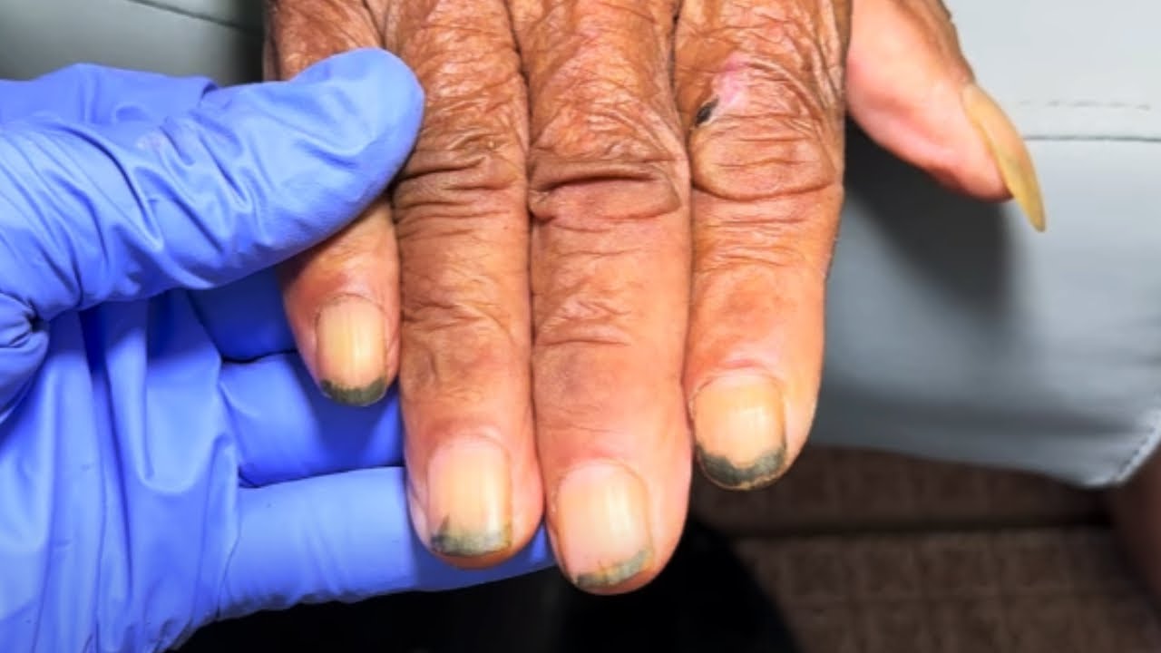 Help Grandpa Trim His Fingernails, Hide A Lot Of Mud [Doctor Liu ...