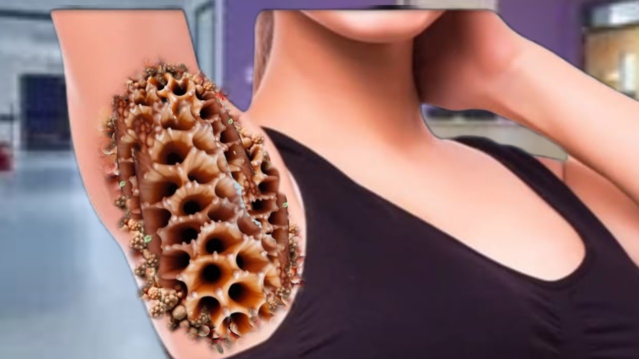 ASMR Animation hand side treatment | ASMR Remove Trypophobia cleaning animation Treatment - YouTube