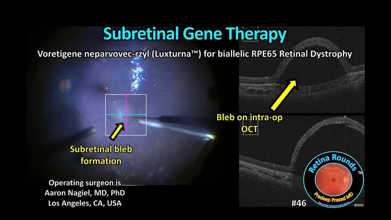 RetinaRounds™ 46: Subretinal Gene Therapy - YouTube