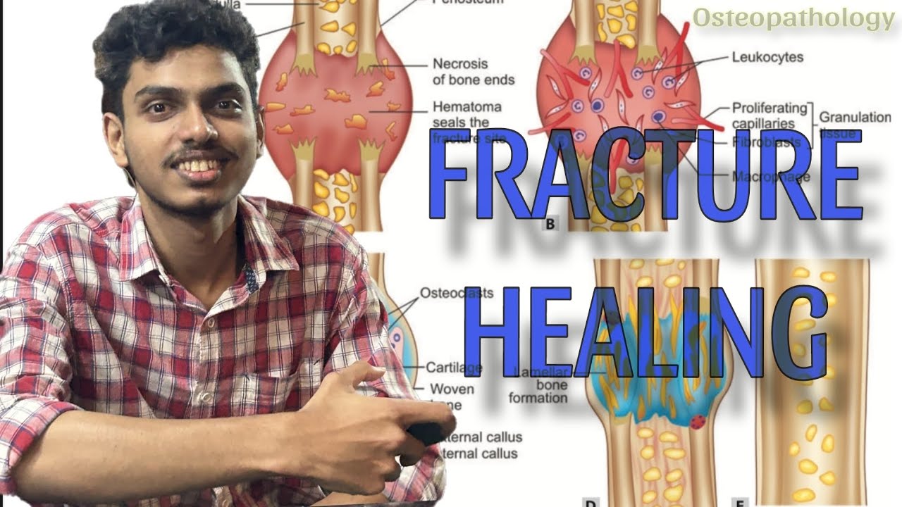 Fracture Healing Malayalam | Osteopathology | എല്ലുപ്പൊട്ടിയാൽ എന്ത് ...