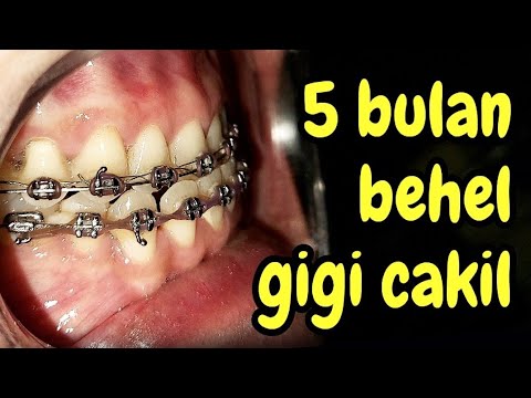 5 bulan perawatan behel gigi cakil, gigi cameh pake behel, dokter gigi ...
