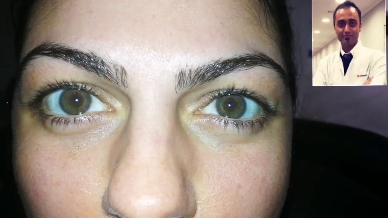 Eye color change laser surgery 8G+ Mylumineyes ®amazing change of eyes ...