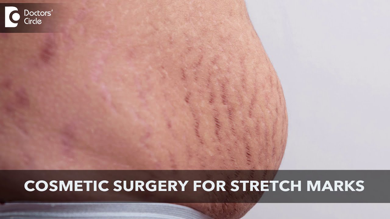 Cosmetic Surgery or Plastic Surgery for Stretch Marks - Dr. Sahebgowda ...