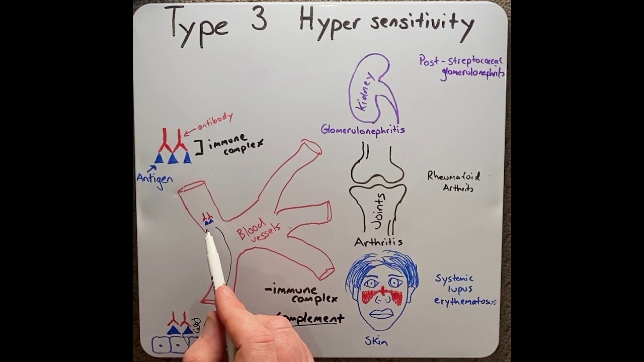 Type 3 hypersensitivity reaction in 2 mins! - YouTube