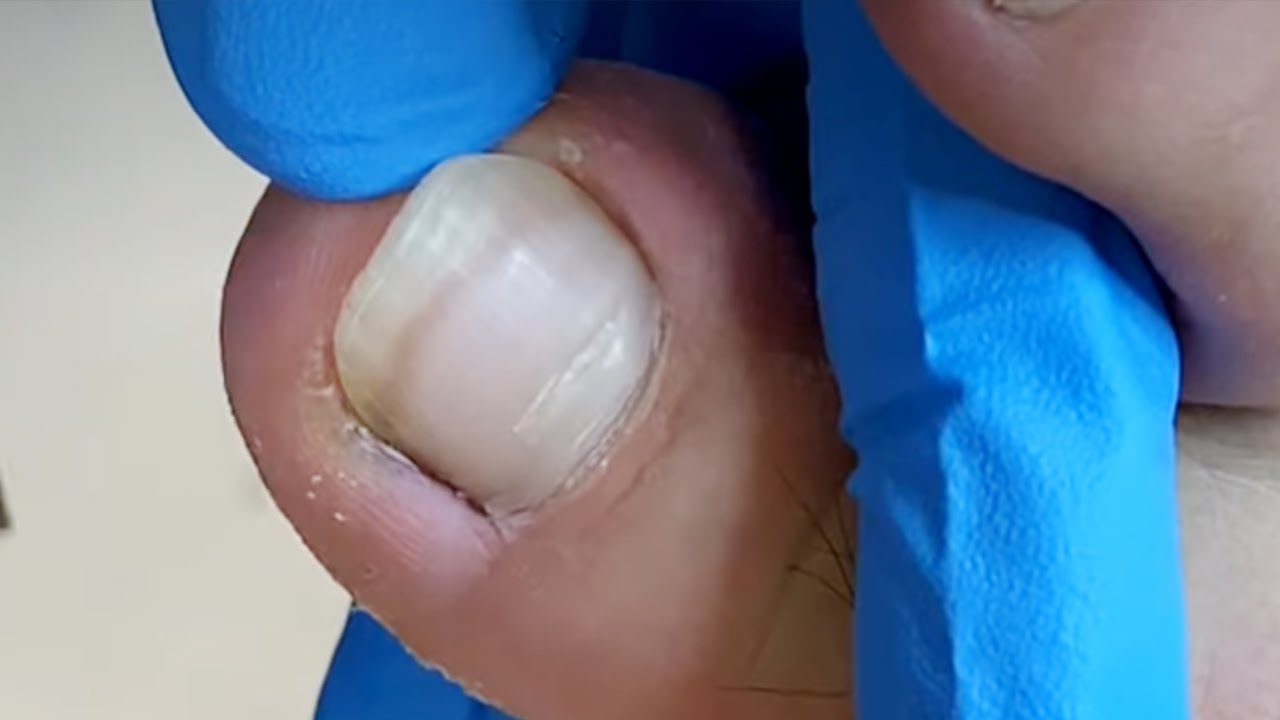 Pedicure tutorial ：Lots of dirt and dander under toenails【Xue Yidao ...