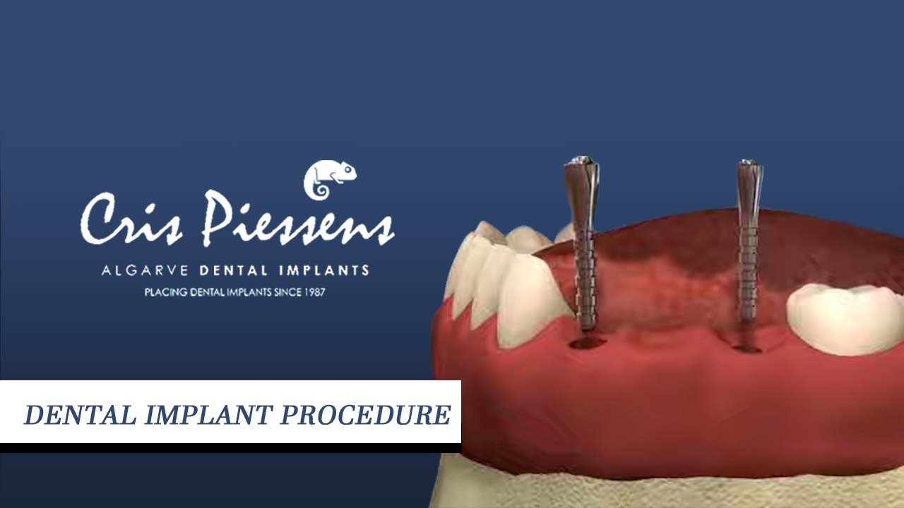 Video Animation of a Dental Implant Procedure | Algarve Dental Implants ...