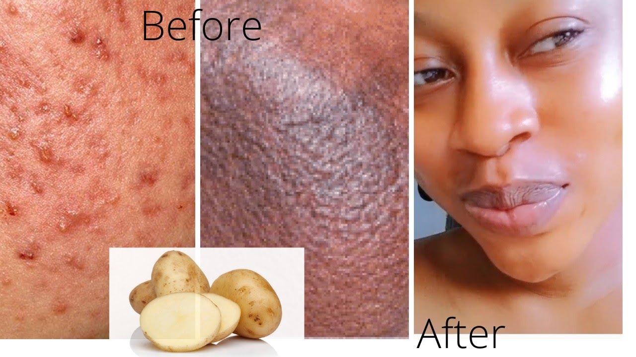 How to Clear Acne|wrinkles|hyperpigmentation parmanetly with POTATO# ...