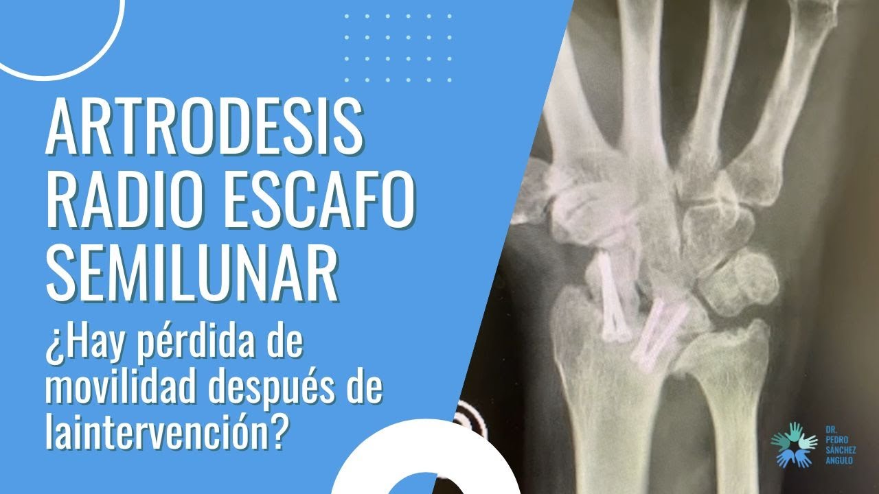 ¿En qué consiste la artrodesis radio-escafo-lunar (RSL)? 👇🏻 - YouTube