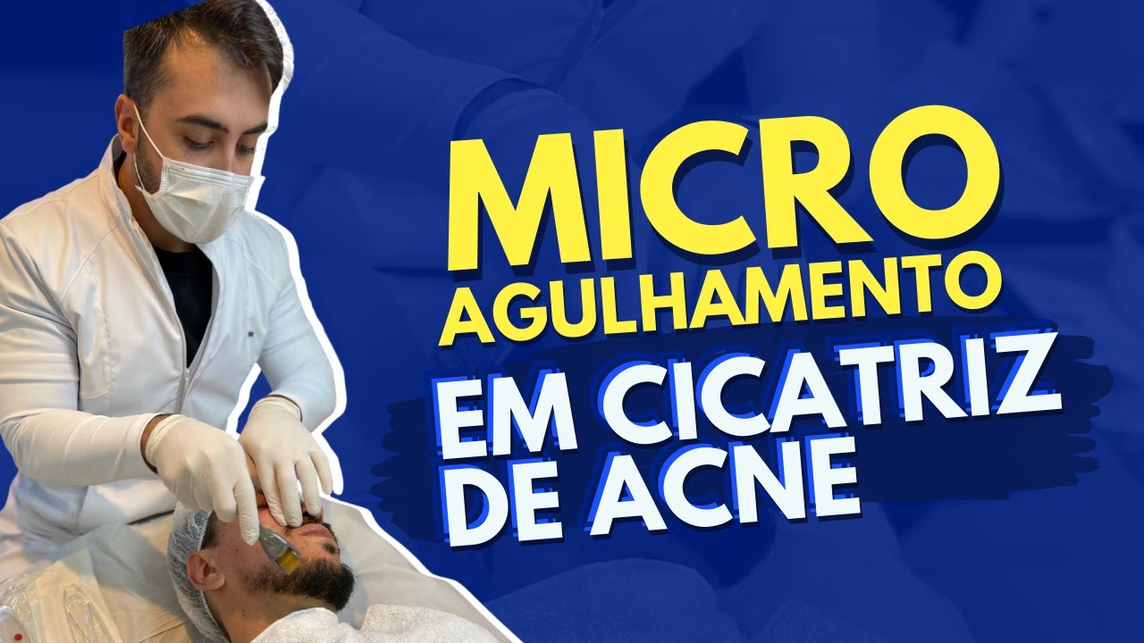 MICROAGULHAMENTO PARA CICATRIZ DE ACNE - YouTube