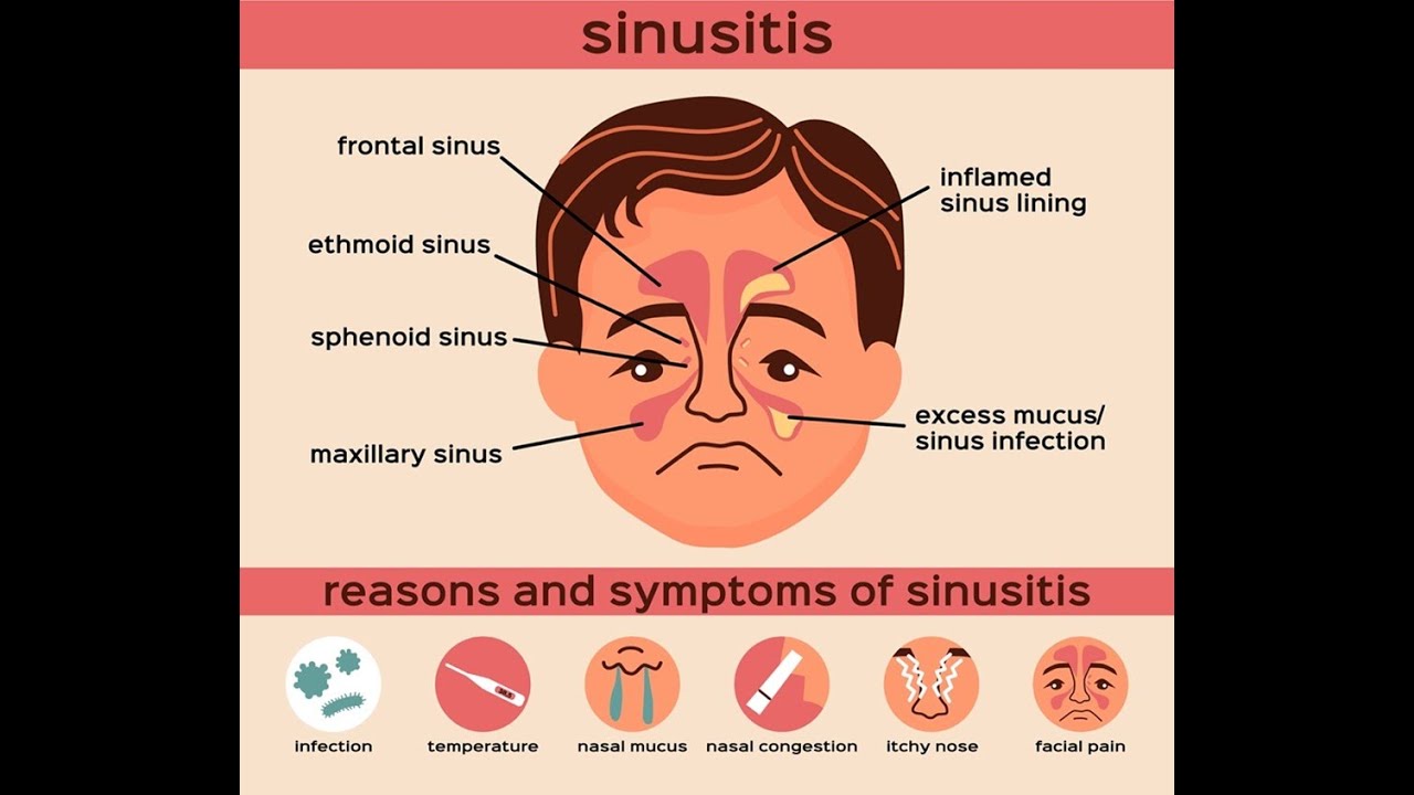 Sinusitis , An inflammation of Sinuses ; Definition, Causes, Symptoms ...