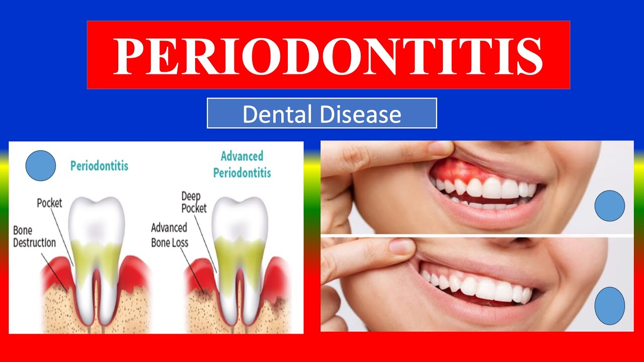 PERIODONTITIS - Definition , types , cusses , Pathophysiology , signs ...