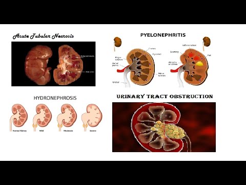 Pathology Urogenital - Tubular Disease & Pyelonephritis ...