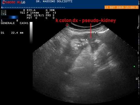 K colon destro - YouTube