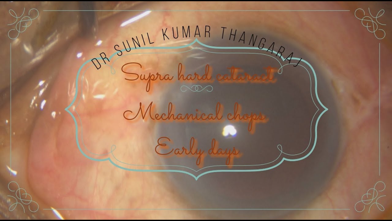 Using the long tipped ball chopper for nuclear disassembly in a supra ...