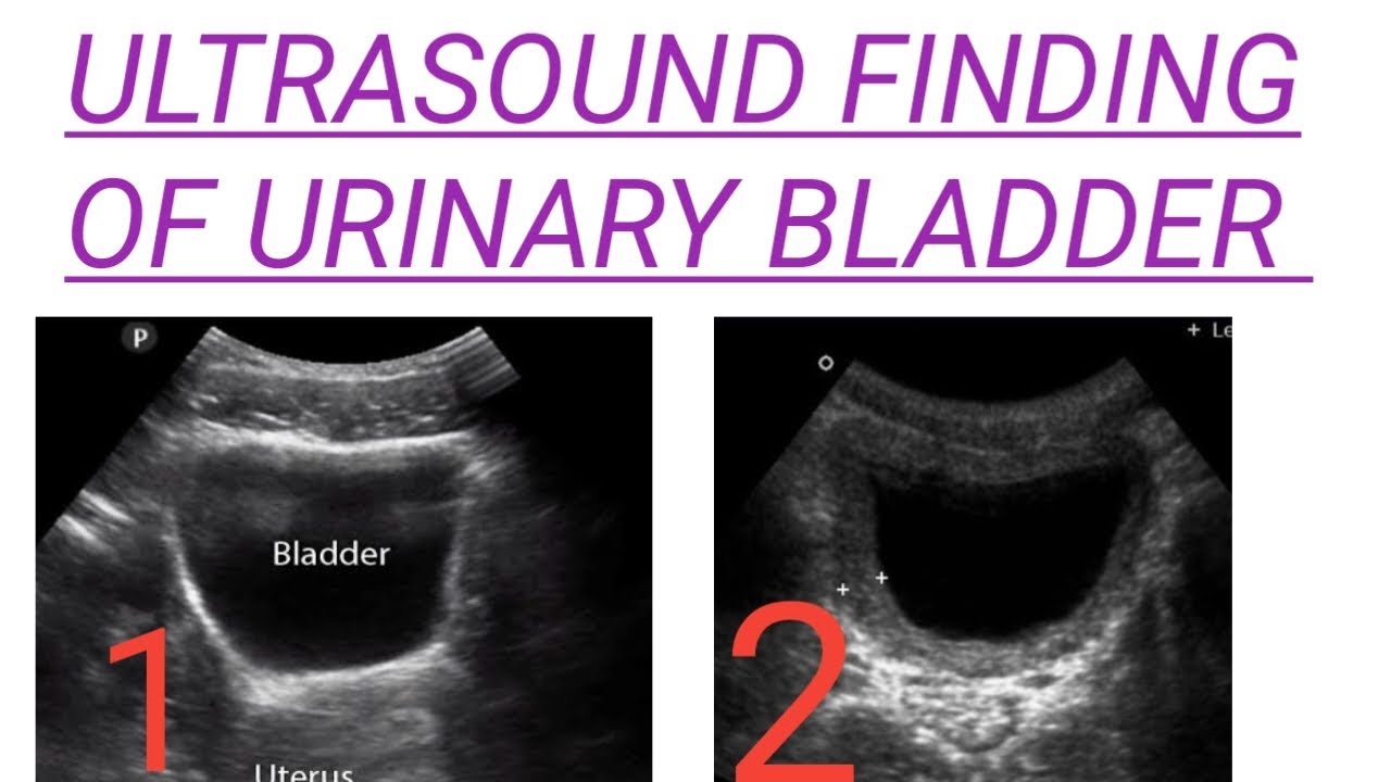 Ultrasound Findings of urinary bladder!Ultrasound KUB!Kub ultrasound ...