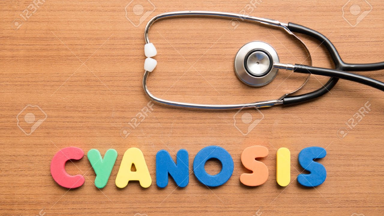 cyanosis by subhajit datta arborvitaenxt medicine - YouTube