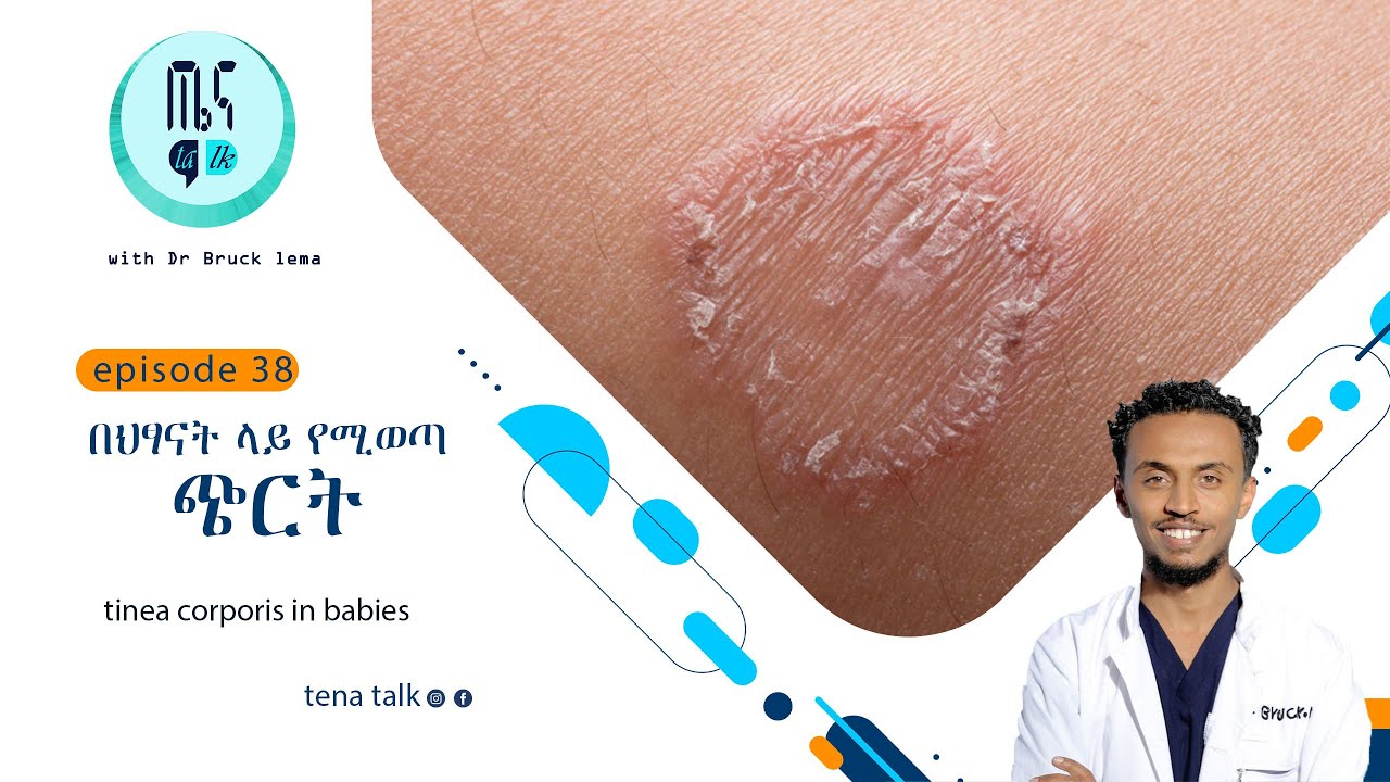 በህፃናት ላይ የሚወጣ ጭርት ring worm (tinea corporis )in babies - YouTube