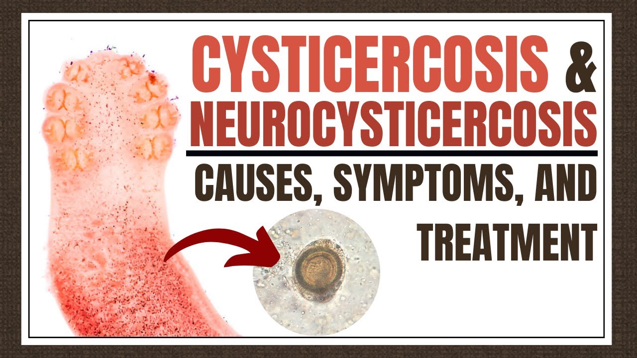 Cysticercosis & Neurocysticercosis: Causes, Symptoms, and Treatment ...