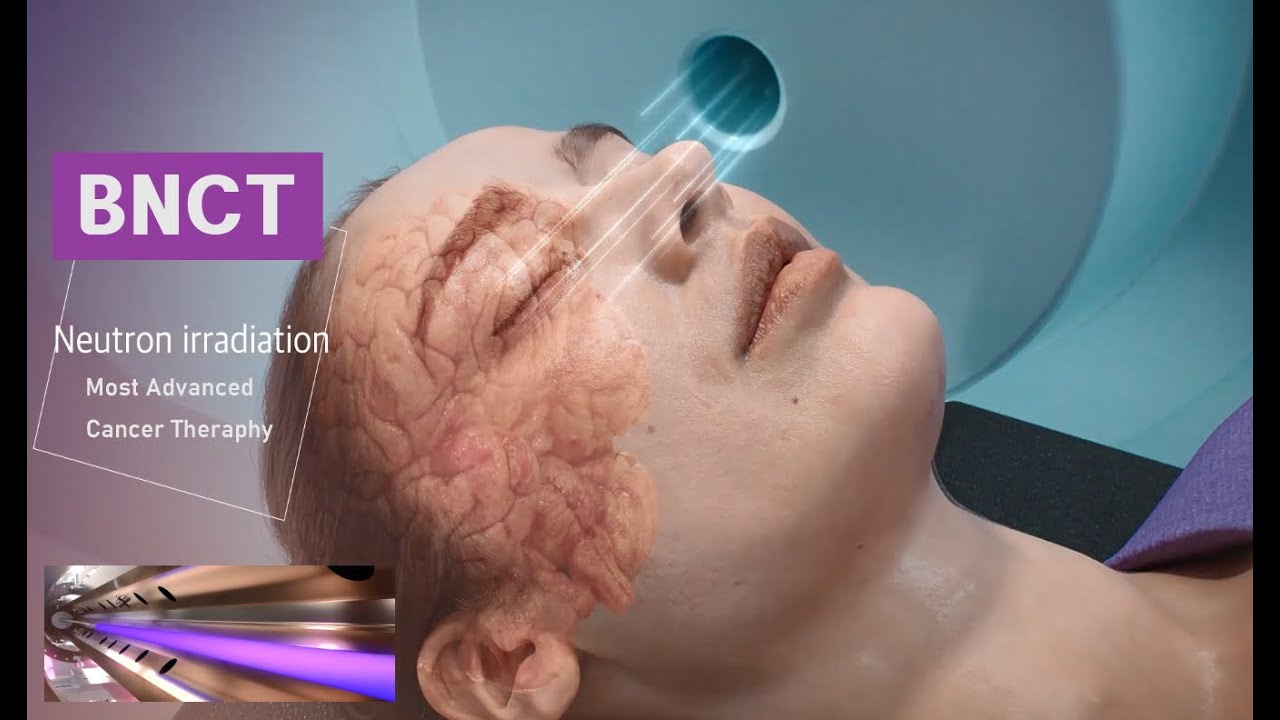 BNCT - newest 4th generation cancer therapy - YouTube