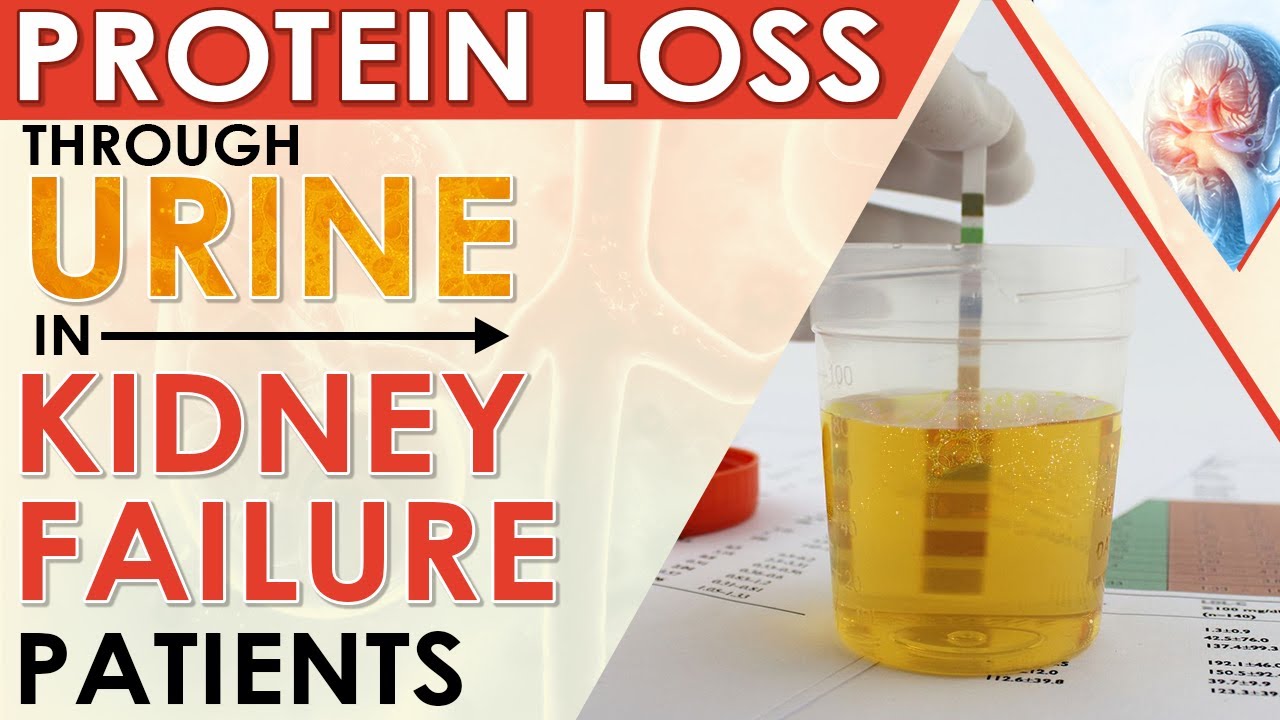 Protein Loss Through Urine In Kidney Failure Patients YouTube Protein Loss Through Urine In Kidney Failure Patients YouTube