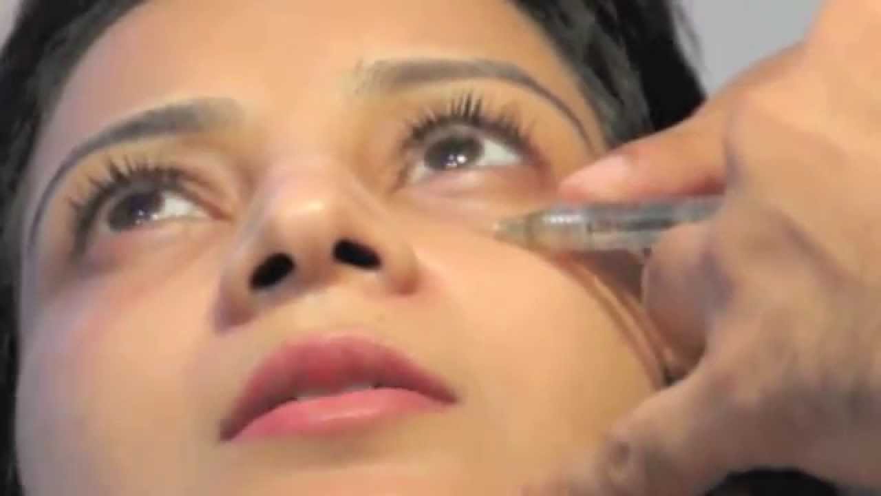 Under Eye Filler Injection - YouTube